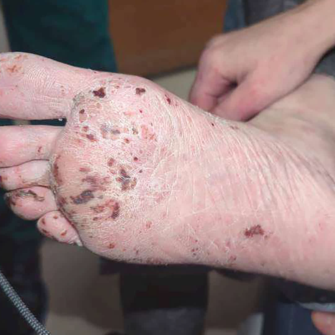 Infective Endocarditis: Diagnosis and Treatment | AFP