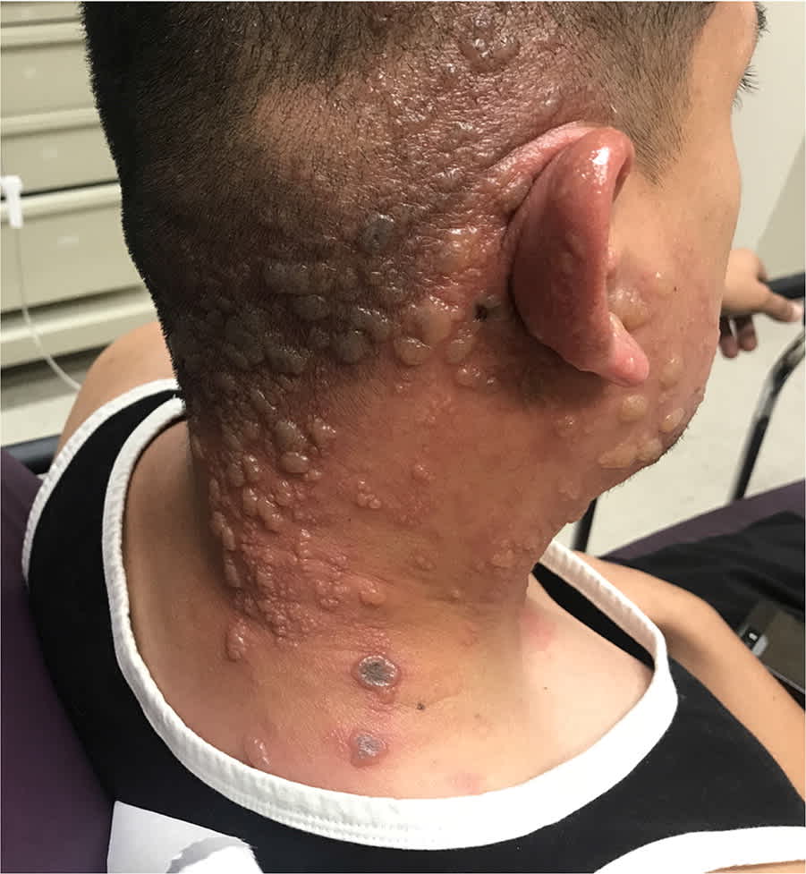 Bullous Rash on the Face and Neck | AFP