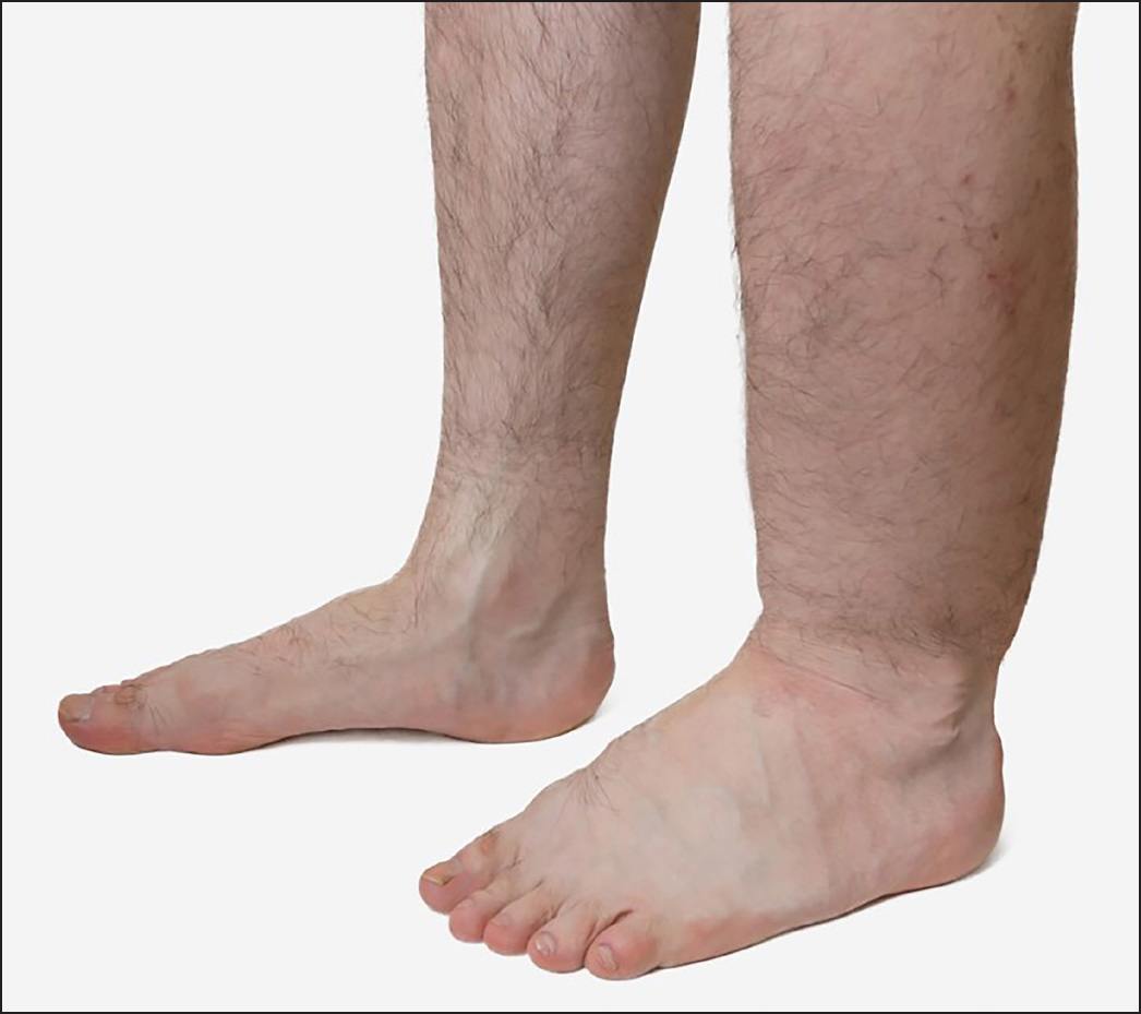 Edema - Cardiovascular Signs and Symptoms | FP Essentials