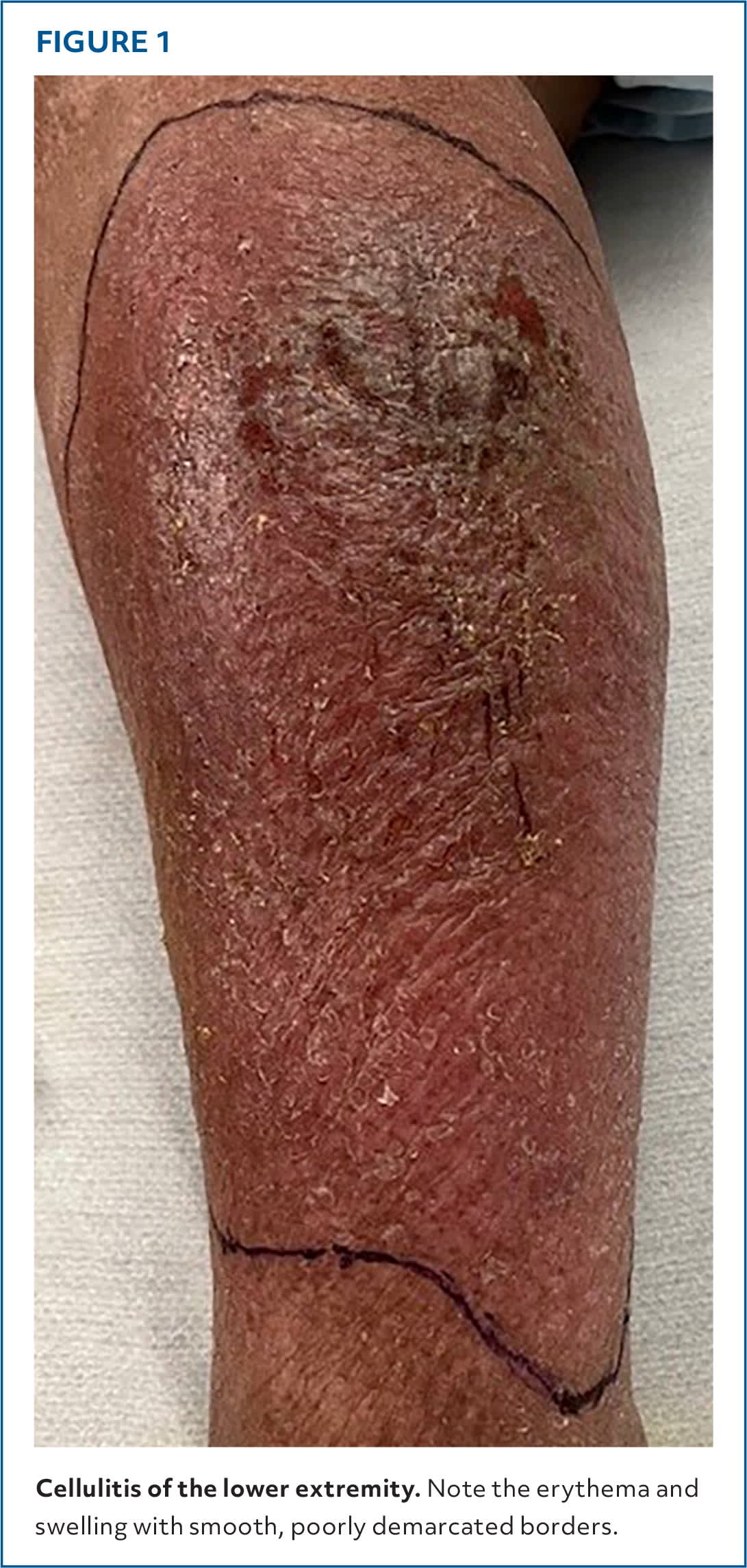 Skin and Soft Tissue Infections | AFP