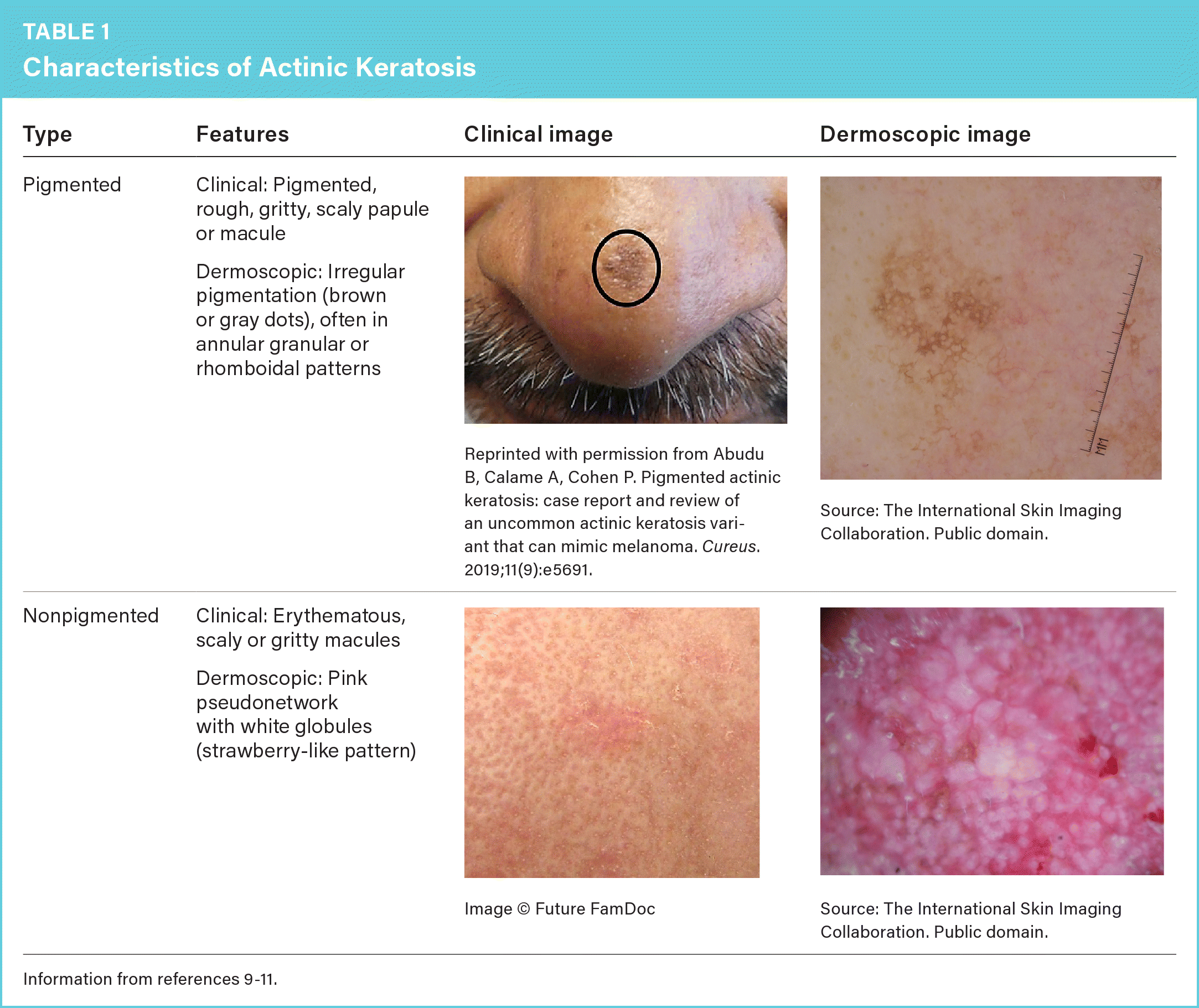 Management of Actinic Keratoses and Keratinocyte Carcinomas - Skin ...